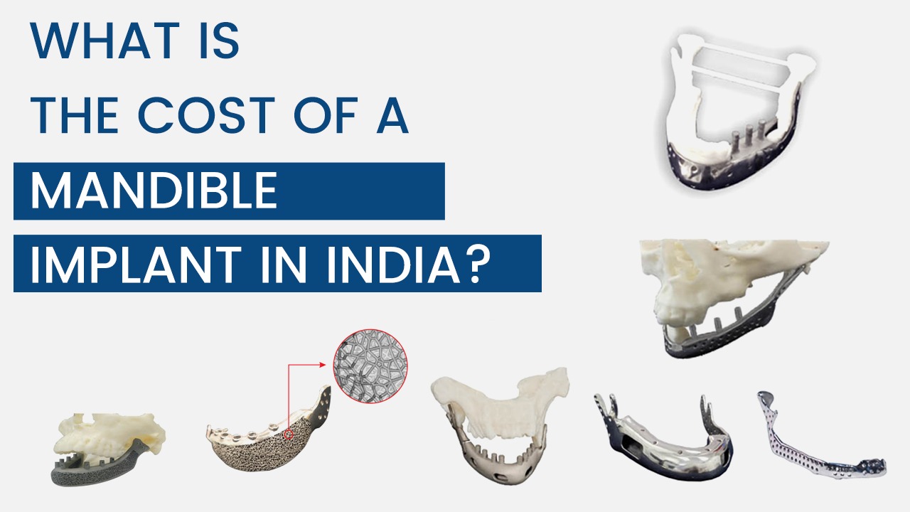 What is the cost of a mandible implant in India? | 3DIncredible
