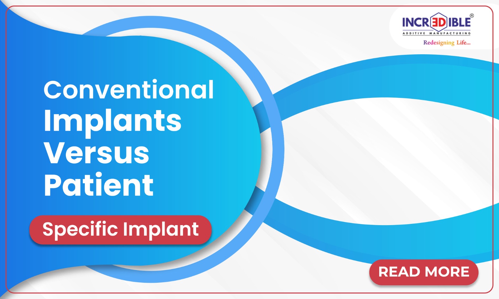 Conventional implants versus patient-specific implant | 3DIncredible