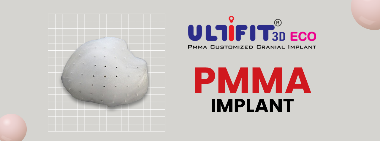 Patient-specific Cranial Implants | 3DIncredible