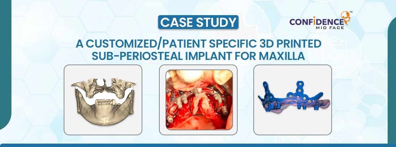 3D Printed Maxillary PSI for Facial Reconstruction | 3D Incredible